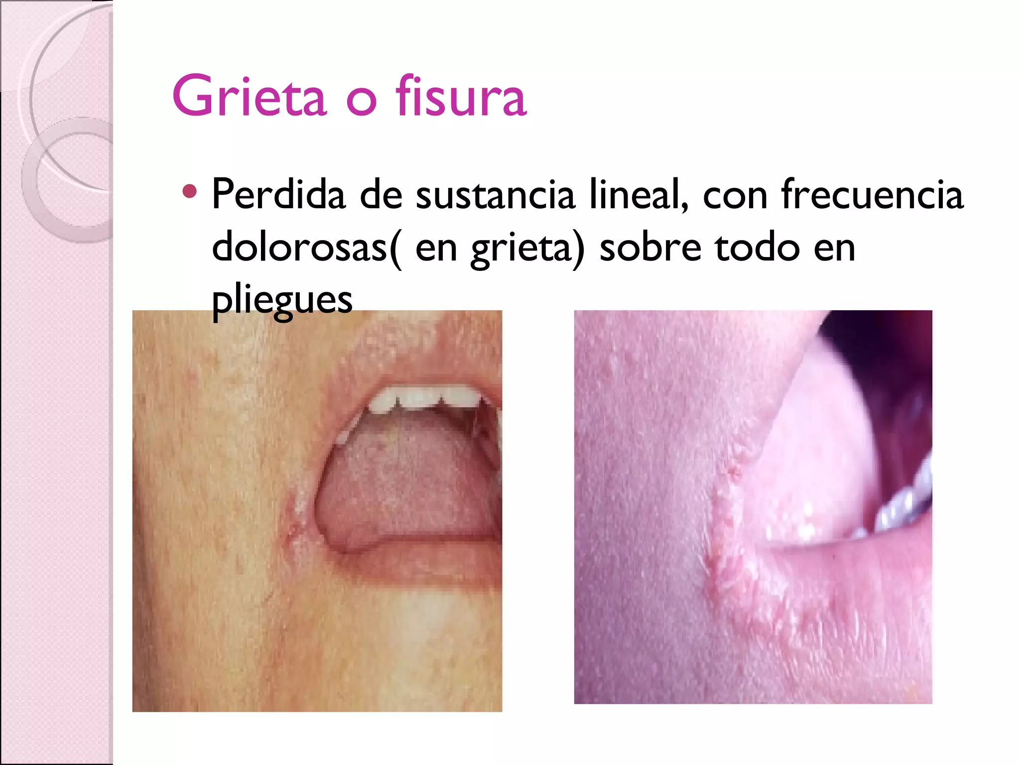 Lesiones Elementales patologia bucal | PPT