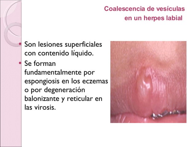 Lesiones Elementales patologia bucal | PPT