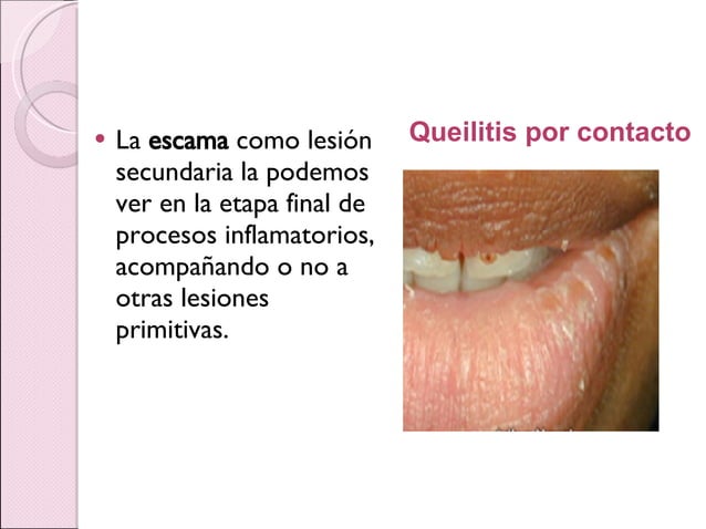 Lesiones Elementales patologia bucal | PPT