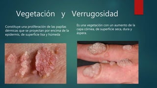 Lesiones elementales primarias | PPTX