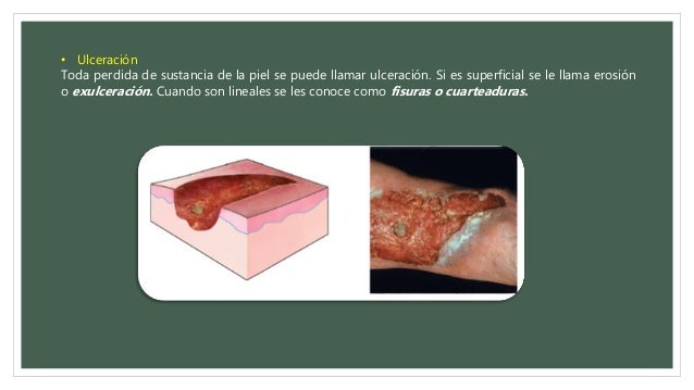 Lesiones elementales