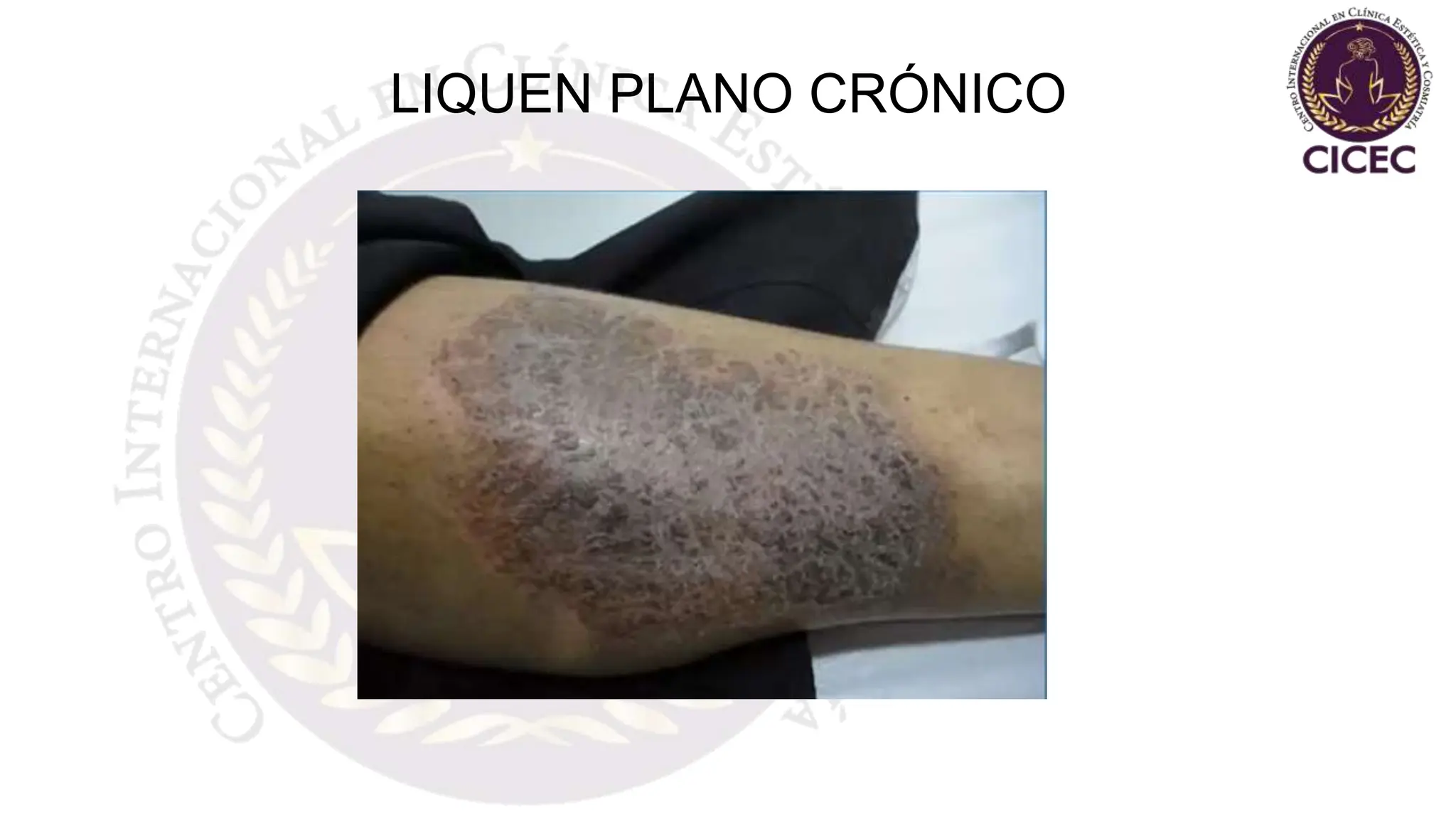 Lesiones elementales primarias y secundarias dermatológicas.pptx
