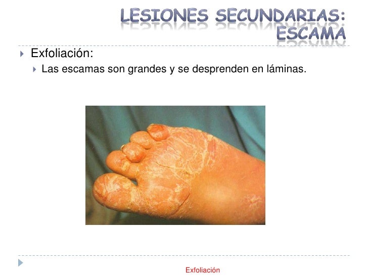 Lesiones elementales de la piel