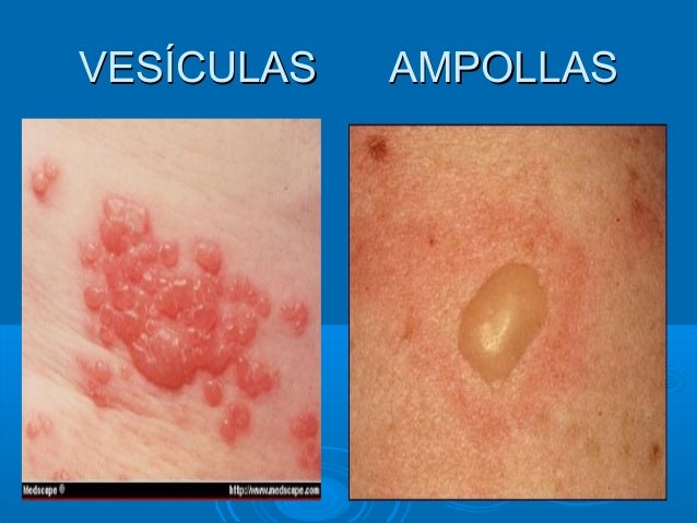Lesiones elementales de la piel