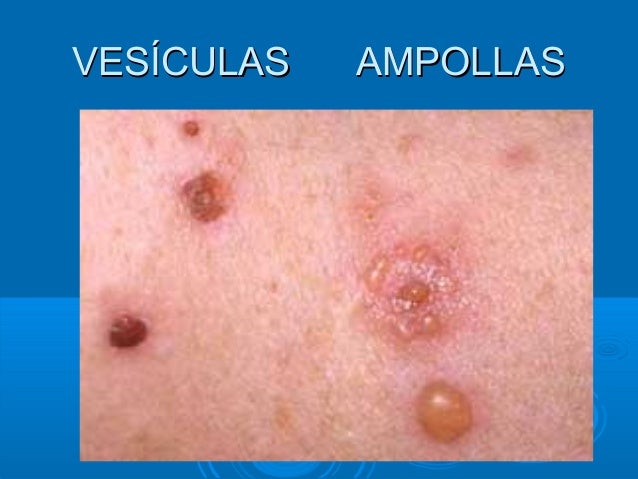 Lesiones elementales de la piel