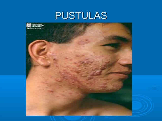 Lesiones elementales de la piel