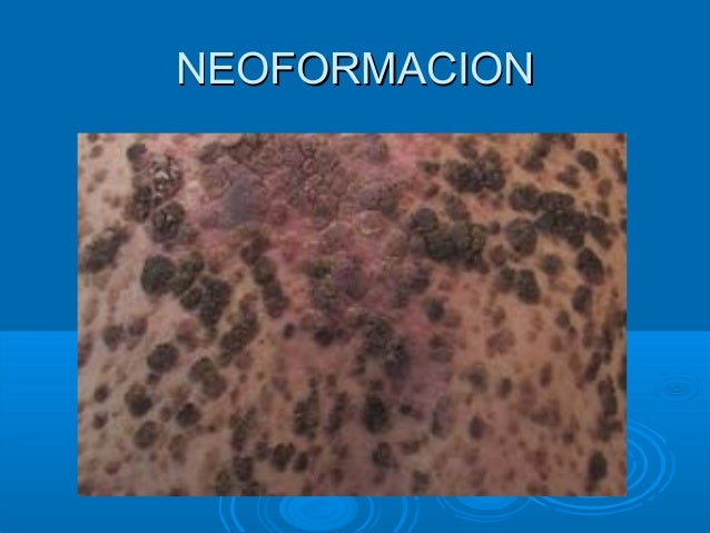 Lesiones elementales de la piel