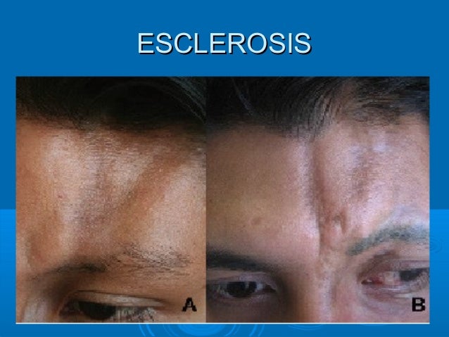 Lesiones elementales de la piel