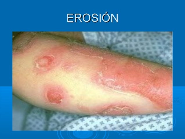 Lesiones elementales de la piel