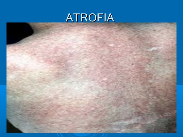 Lesiones elementales de la piel