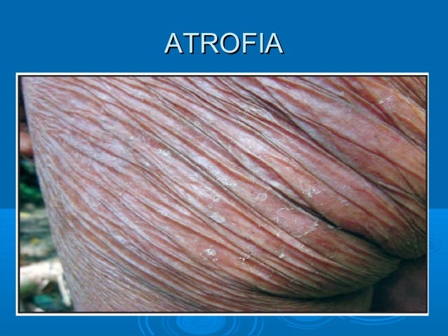 Lesiones elementales de la piel