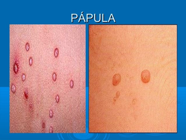 Lesiones elementales de la piel