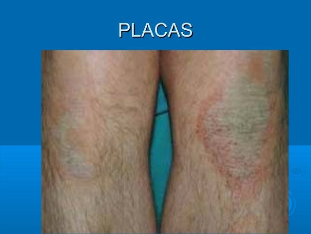 Lesiones elementales de la piel