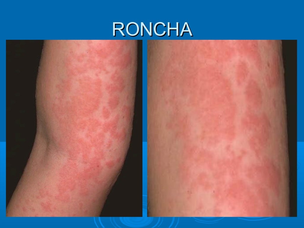 Lesiones elementales de la piel