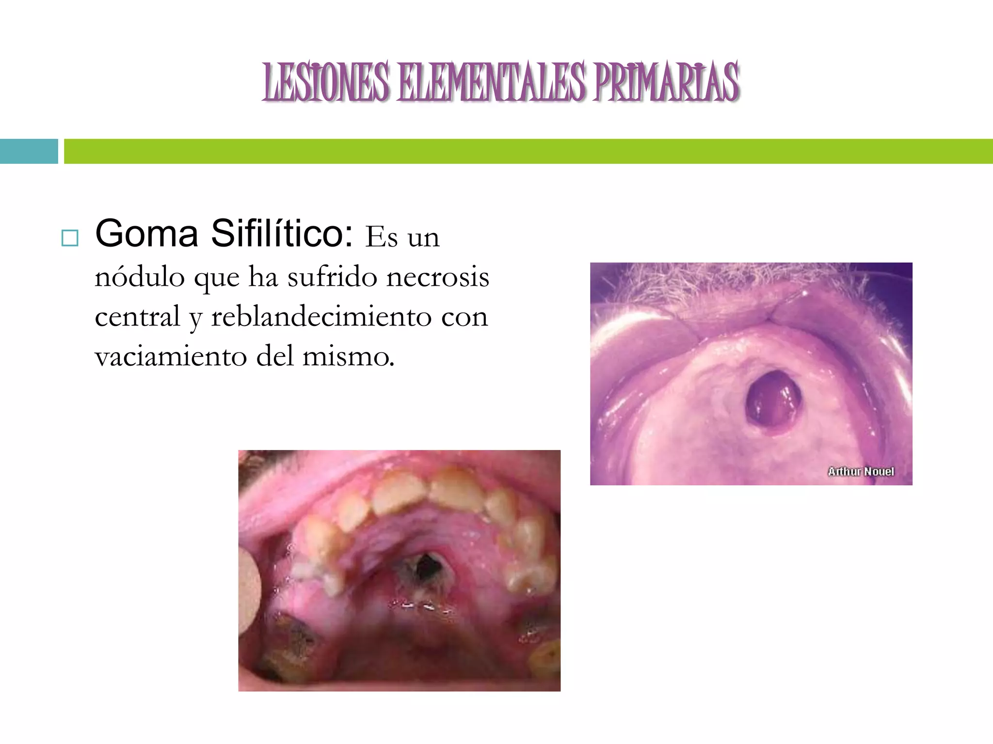 Lesiones elementales de la piel. PRIMARIAS Y SECUNDARIAS. | PPTX