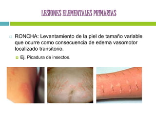 Lesiones elementales de la piel. PRIMARIAS Y SECUNDARIAS. | PPTX