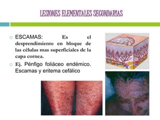 Lesiones elementales de la piel. PRIMARIAS Y SECUNDARIAS. | PPTX