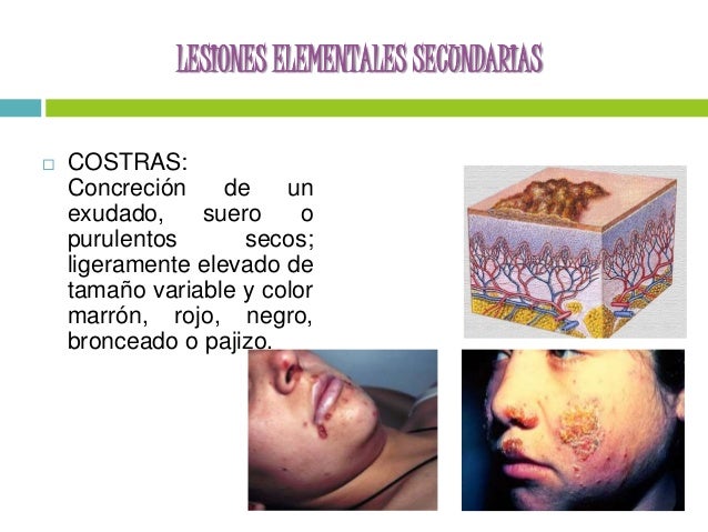 Lesiones elementales de la piel. PRIMARIAS Y SECUNDARIAS.