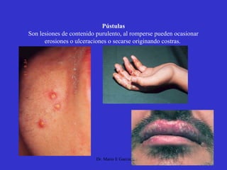 Lesiones elementales de piel | PPT