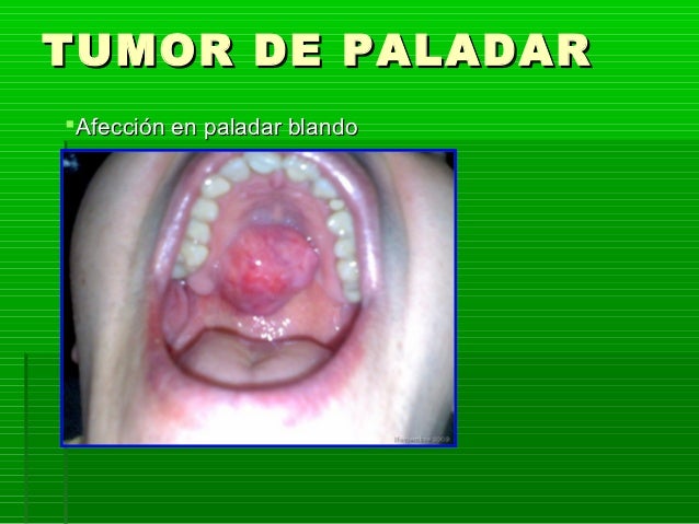 Lesiones elementales en la cavidad bucal