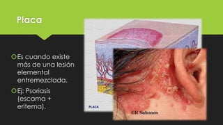 Lesiones elementales secundarias de la piel, semiologia | PPTX
