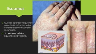Lesiones elementales secundarias de la piel, semiologia | PPTX