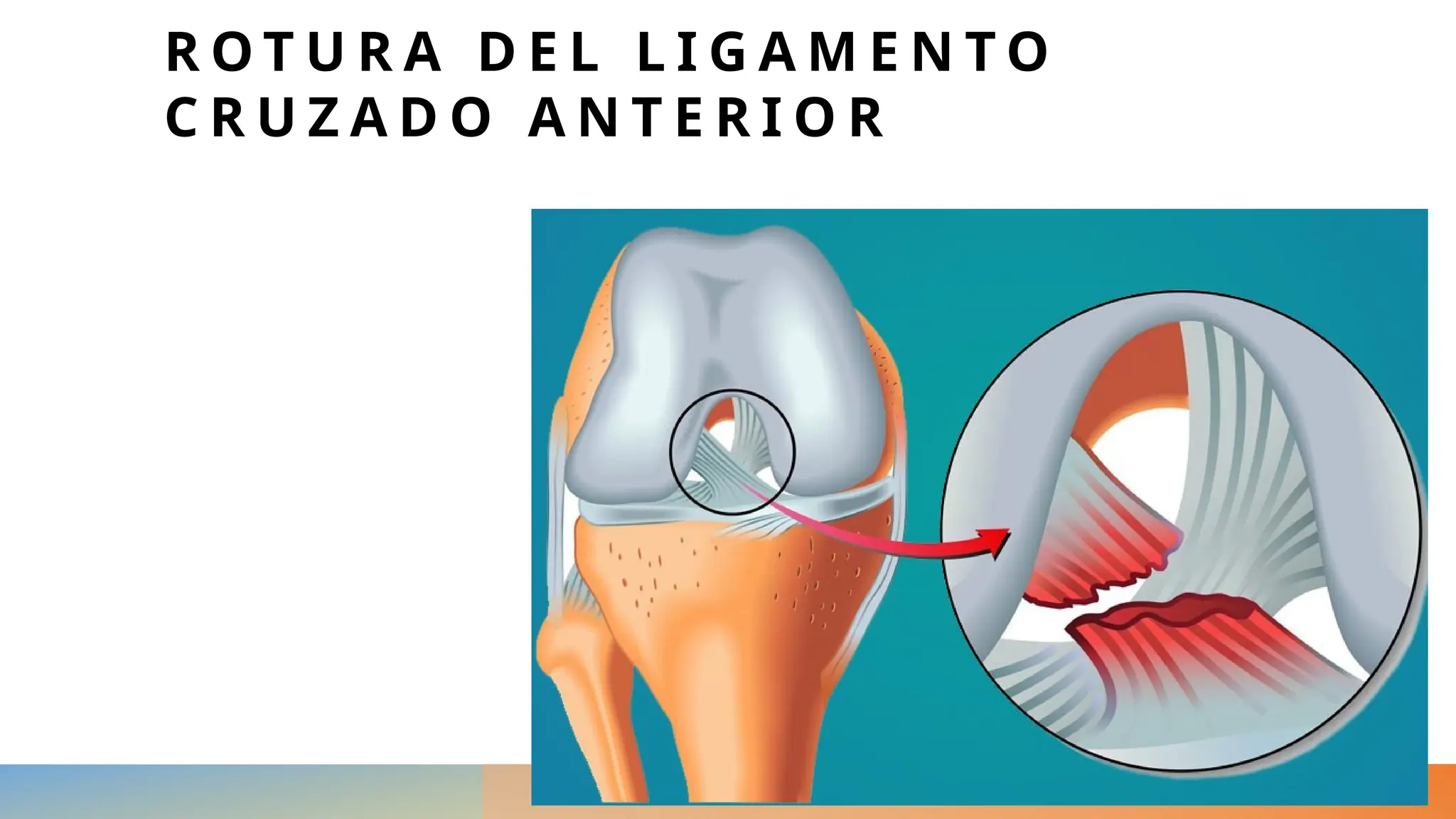 Lesiones en ligamentos de la rodilla.pptx