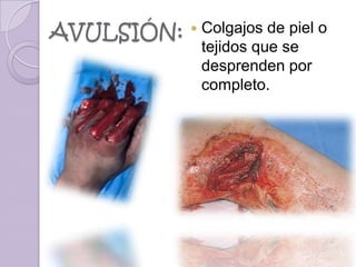 Lesiones en Tejidos Blandos | PPTX