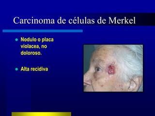 LESIONES EPIDERMICAS MALIGNAS - CANCER DE PIEL | PPTX