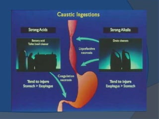 Lesiones esofagica por caustico | PPTX