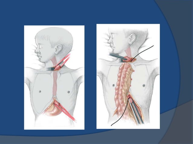 Lesiones esofagica por caustico
