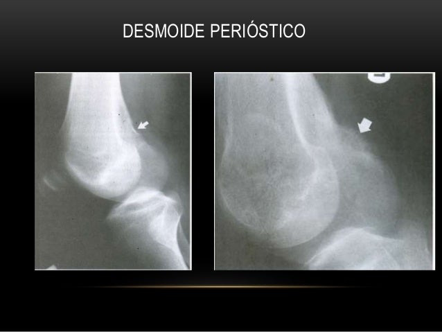 Lesiones fibrosas, fibrooseas y fibrohistiociticas