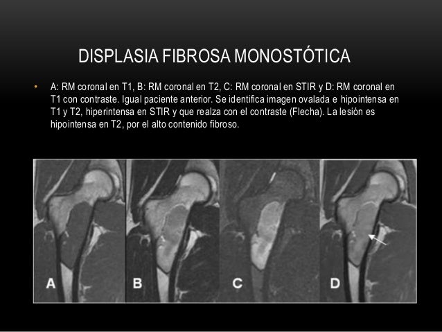 Lesiones fibrosas, fibrooseas y fibrohistiociticas