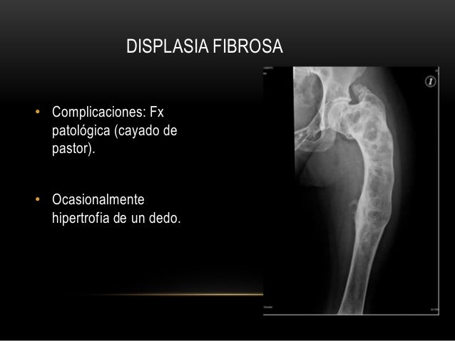 Lesiones fibrosas, fibrooseas y fibrohistiociticas