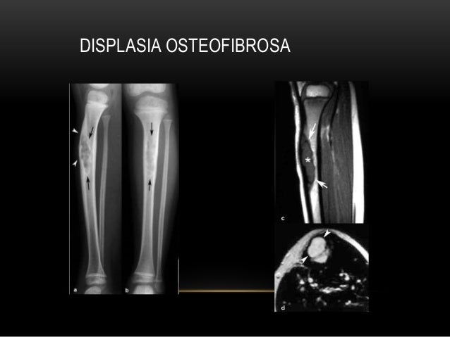 Lesiones fibrosas, fibrooseas y fibrohistiociticas