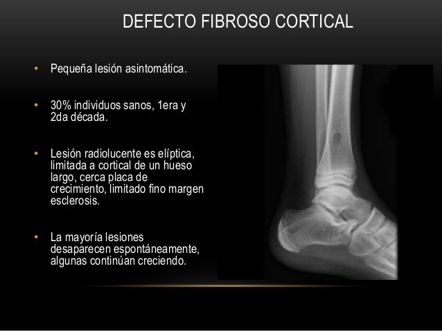 Lesiones fibrosas, fibrooseas y fibrohistiociticas