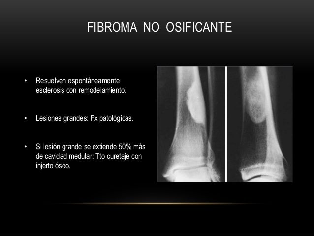 Lesiones fibrosas, fibrooseas y fibrohistiociticas
