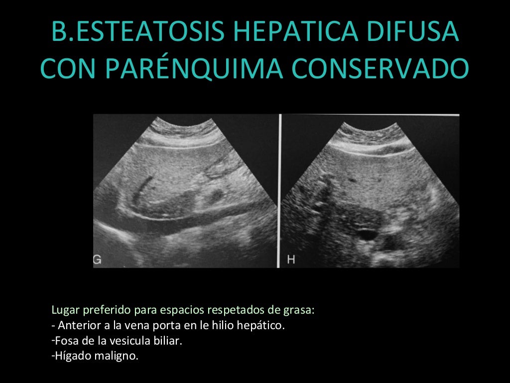 DIAGNOSTICO DIFERENCIAL DE LESIONES FOCALES HEPÁTICAS EN ECOGRAFÍA