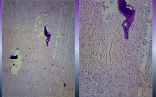 Lesiones hiperplasicas de tejido fibroso. rm m ayhuasca | PDF