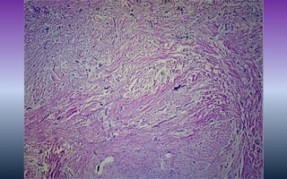 Lesiones hiperplasicas de tejido fibroso. rm m ayhuasca | PDF