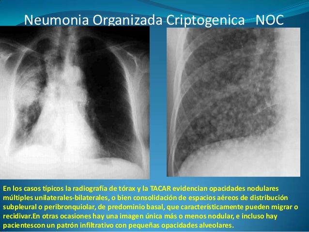 Lesiones intersticiales