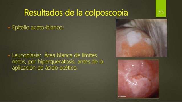 Lesiones intraepiteliales cervicales