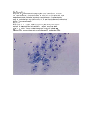Lesiones intraepiteliales escamosas | DOCX