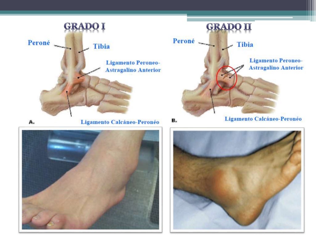 Lesiones ligamentosas de tobillo
