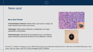 Lesiones Melanocíticas y Nevus congénitos.pptx