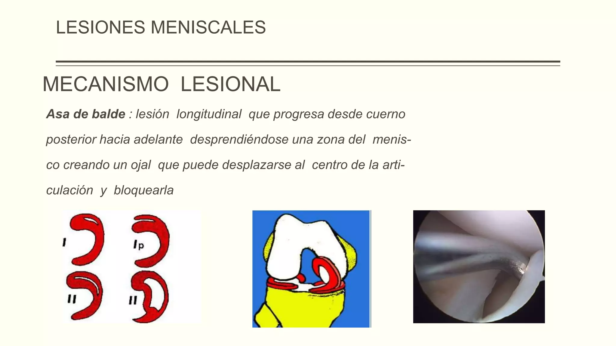 Manejo traumatológico de lesiones meniscales