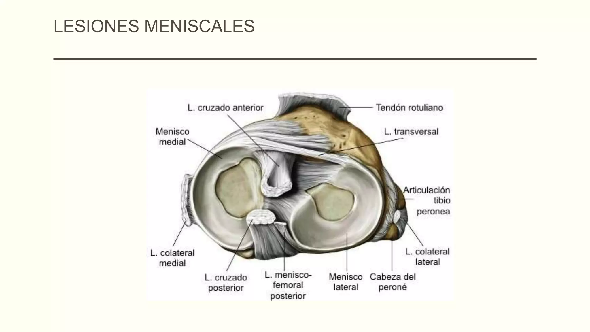 Manejo traumatológico de lesiones meniscales