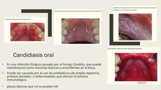 Lesiones orales mas comunes en odontologia.pptx