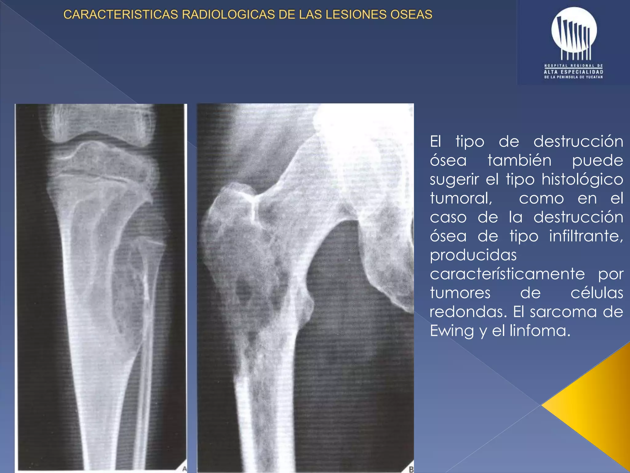 Caracteristicas Radiologicas de las Lesiones Oseas | PPTX