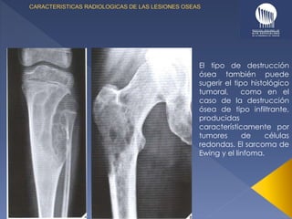 Caracteristicas Radiologicas de las Lesiones Oseas | PPTX